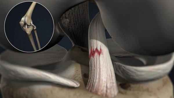 علاج قطع الرباط الصليبي الأمامي (ACL) - د/ هشام عبد الباقي