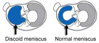 Discoid meniscus - Hip and Knee clinic