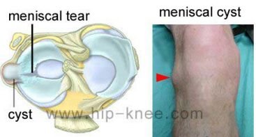 Meniscal cysts - Hip and Knee clinic