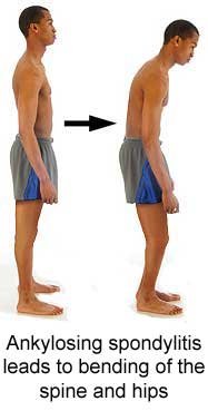 Ankylosing spondylitis - Hip and Knee clinic